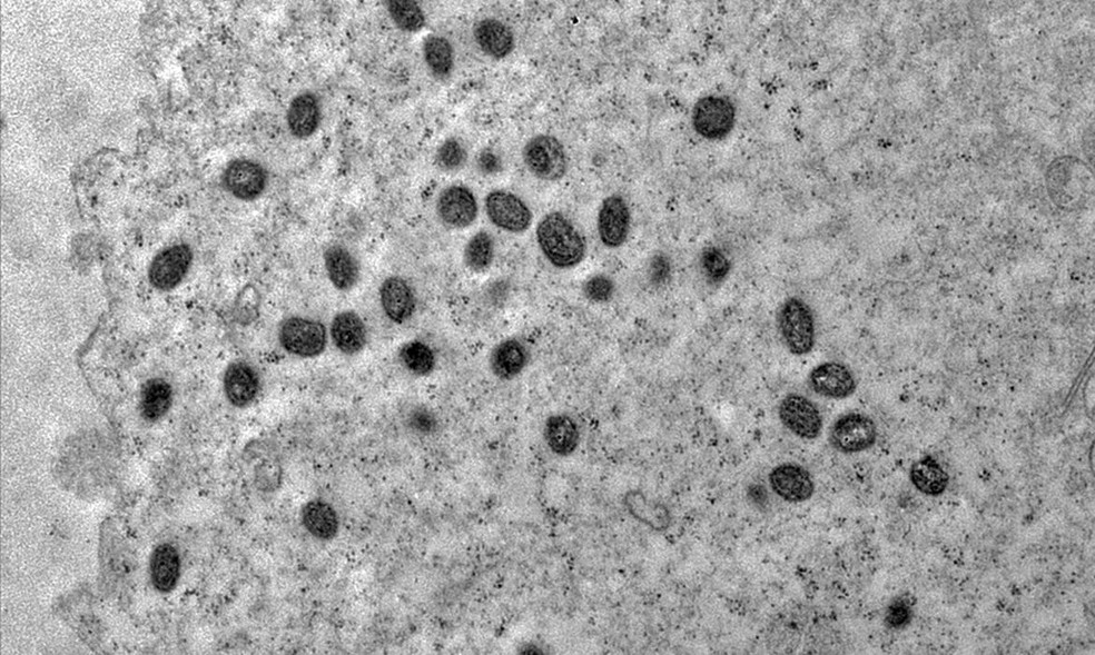 Pesquisa indica risco de monkeypox agravar infeccão por HIV | Ciência e ...