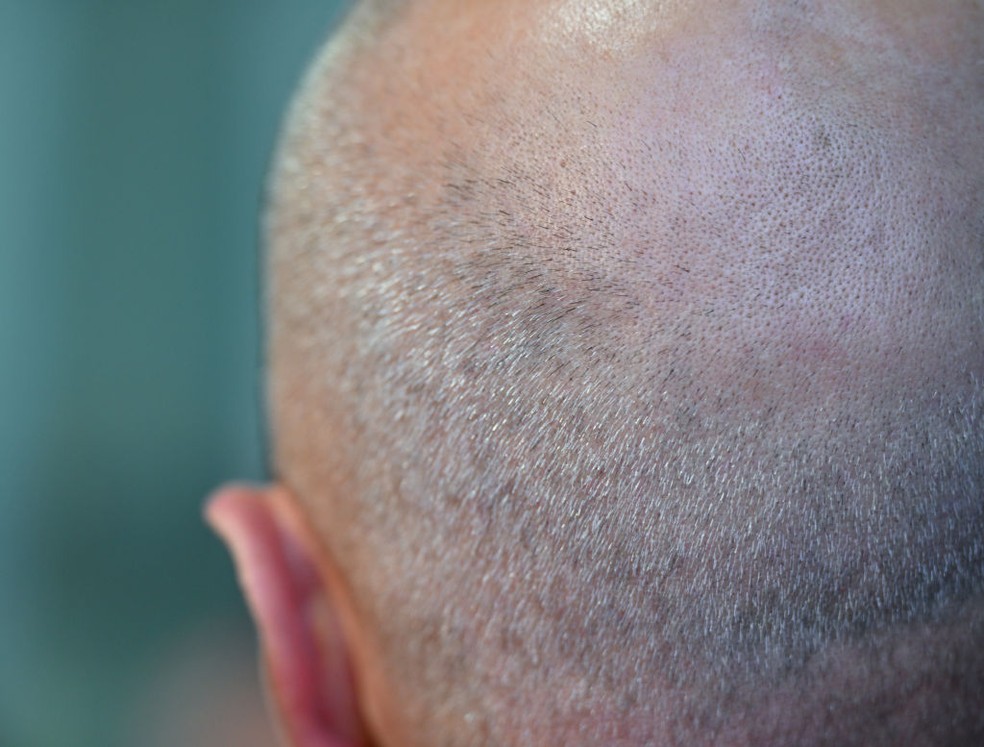 Cientistas descobrem tipo de açúcar que pode ajudar na cura da calvície ...